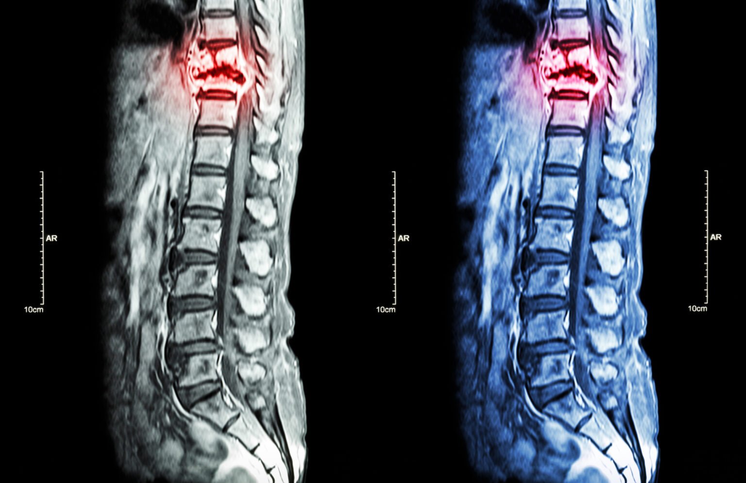 The Different Spinal Fracture Types Explained - DecoBizz Lifestyle Blog